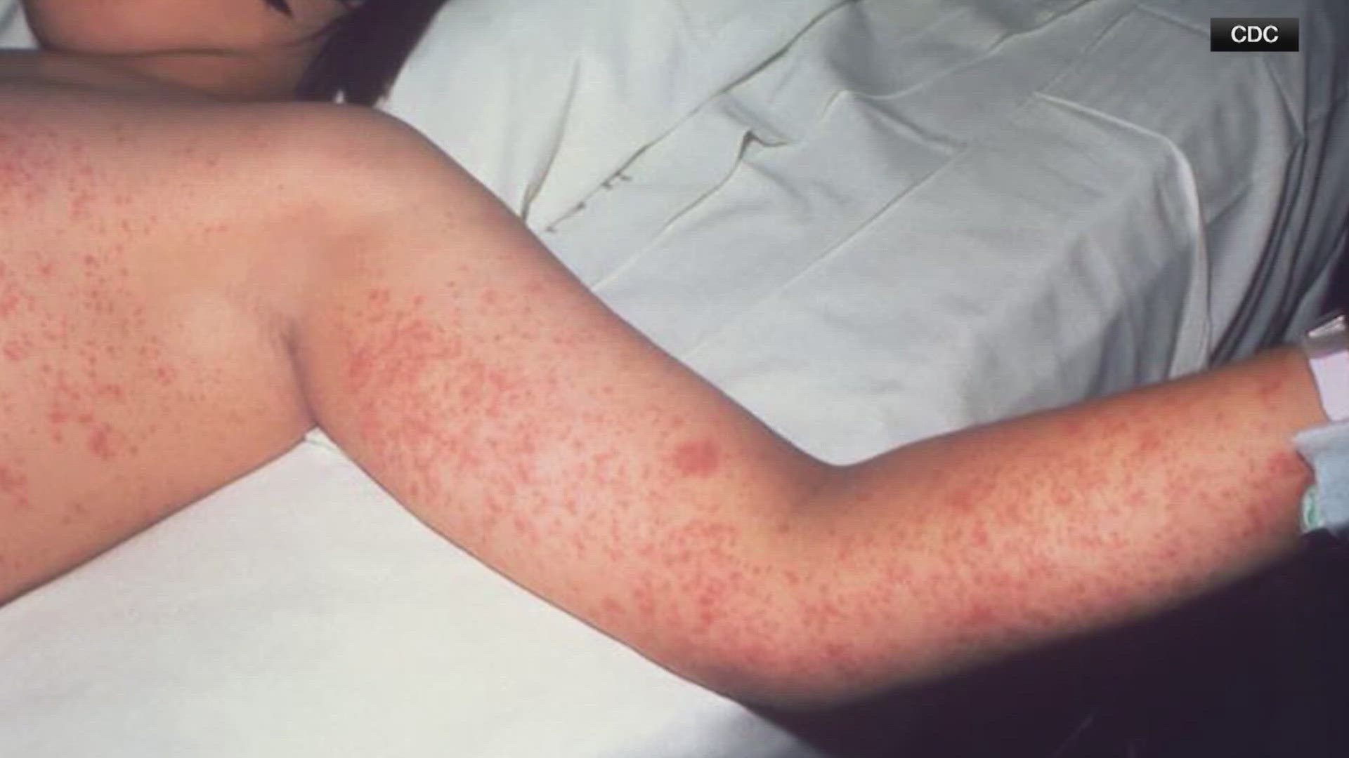 Measles very contagious; but before the rash it seems just like a cold ...
