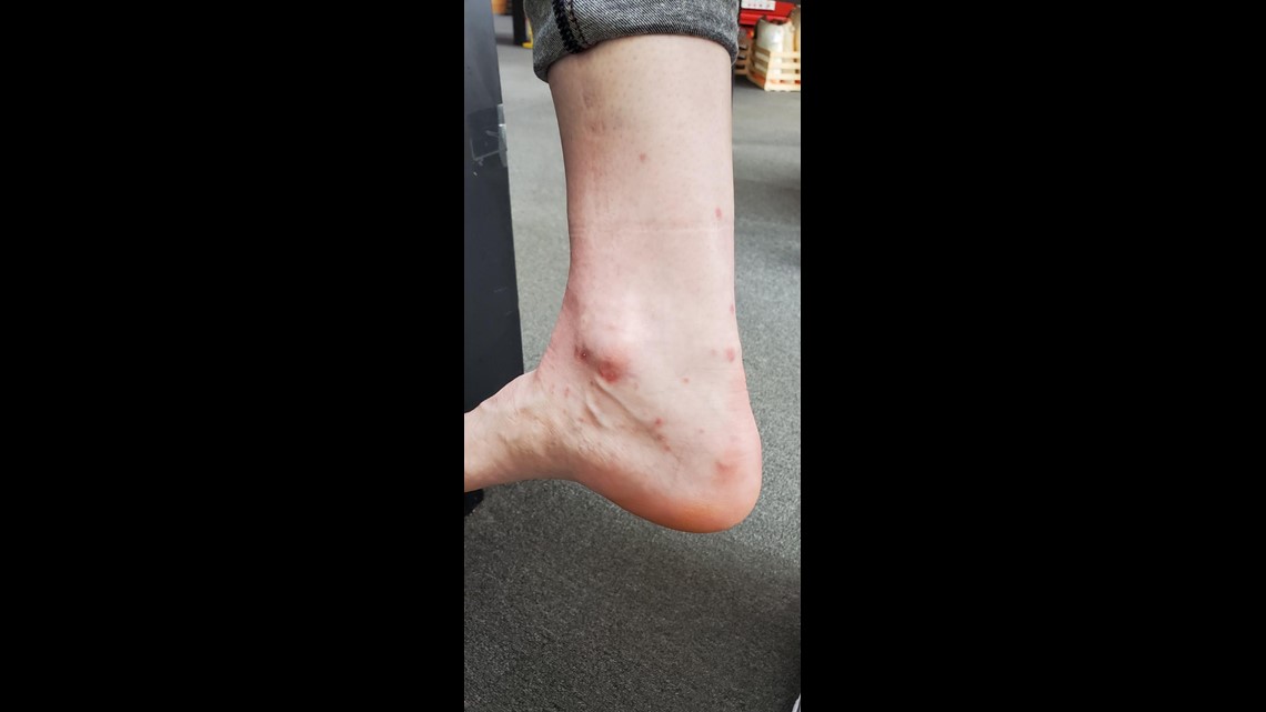 How to avoid getting bit by chiggers | ksdk.com