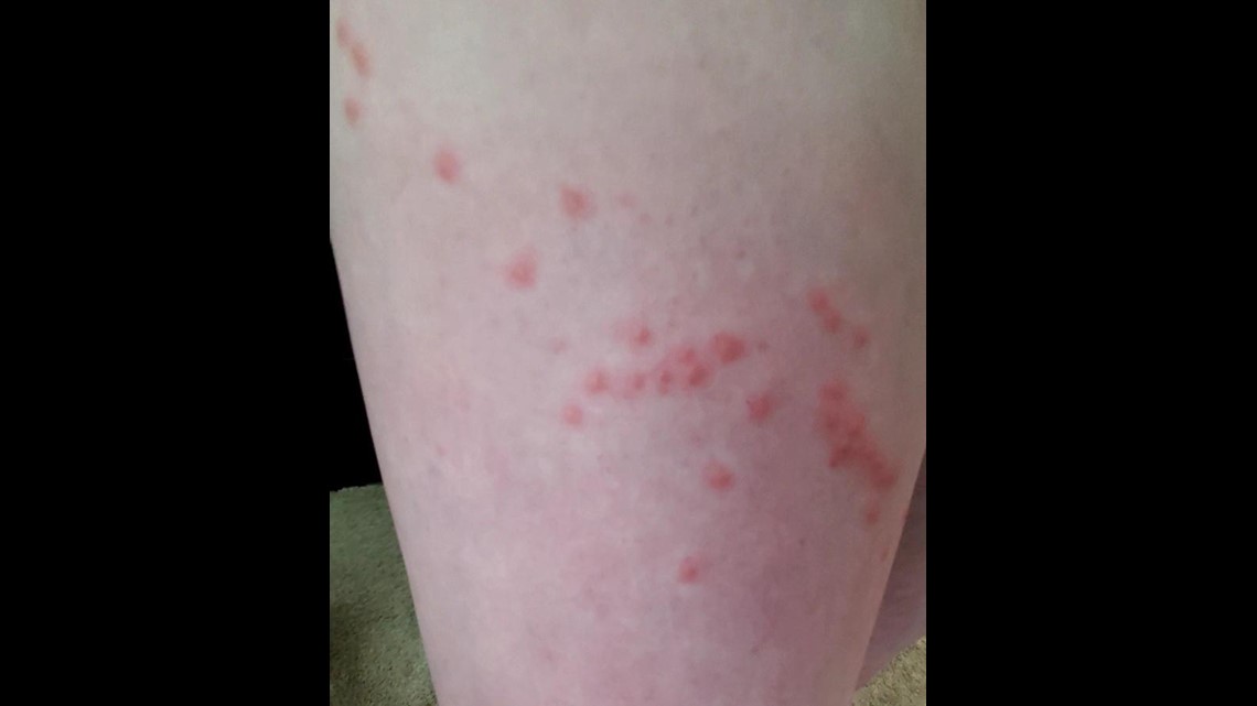 How to avoid getting bit by chiggers | ksdk.com