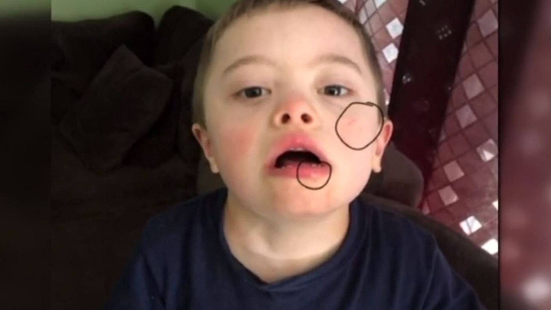 Special needs child comes home from school with bruises and scratches ...