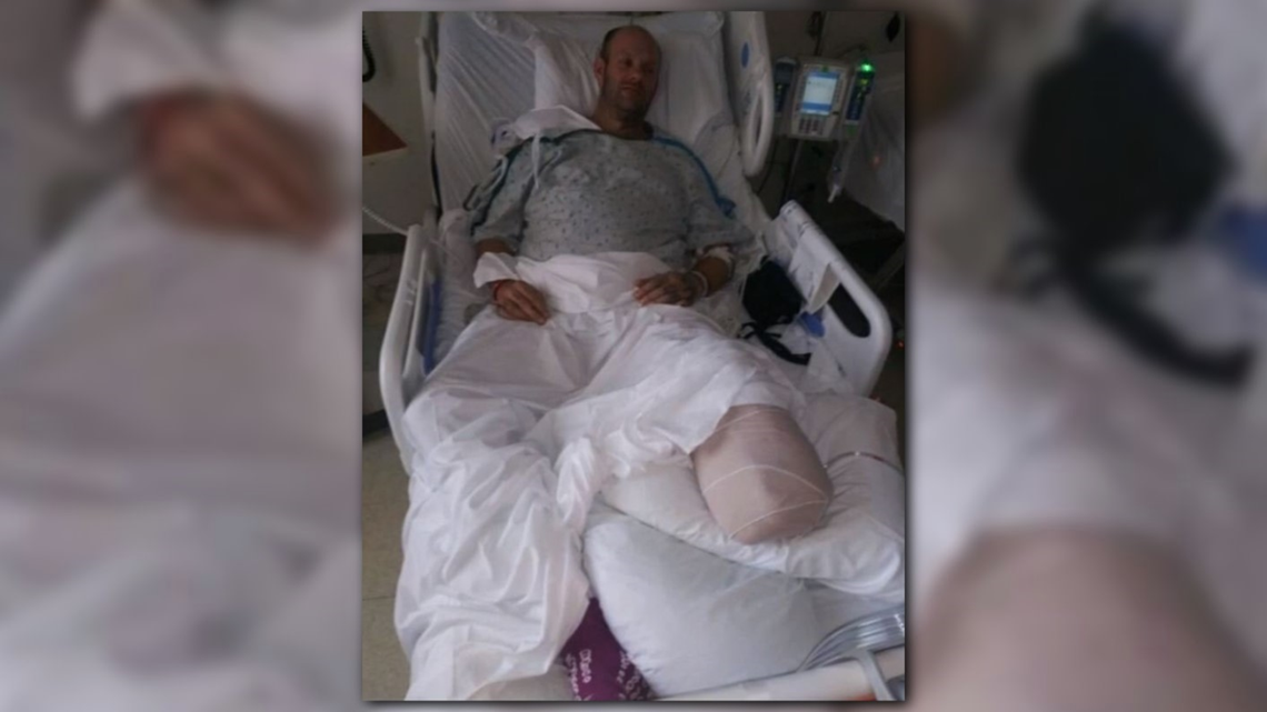 Man has part of leg amputated after hit-and-run | ksdk.com