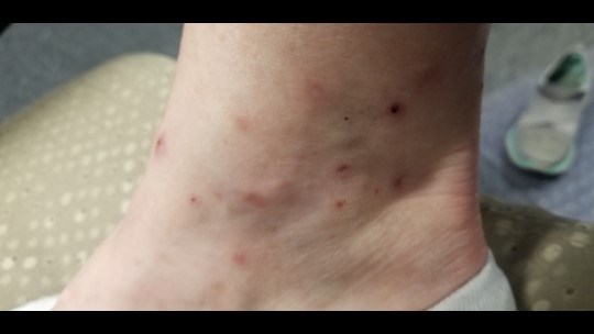 How to avoid getting bit by chiggers | ksdk.com