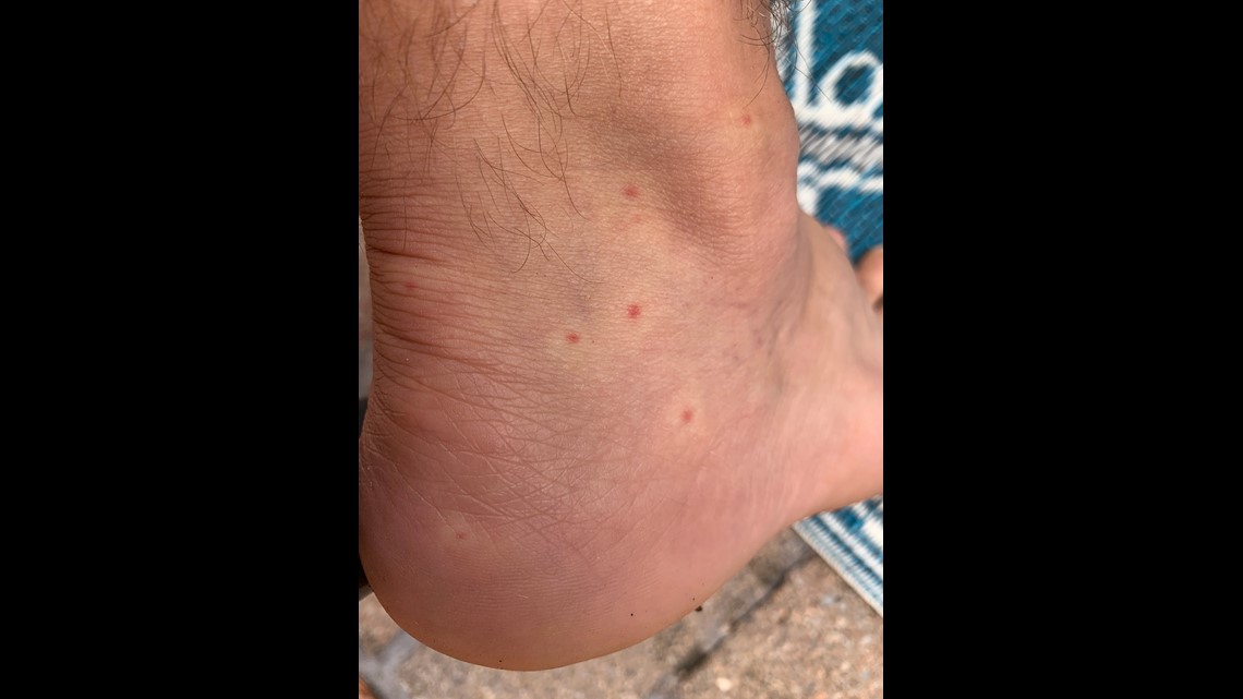 How To Avoid Getting Bit By Chiggers