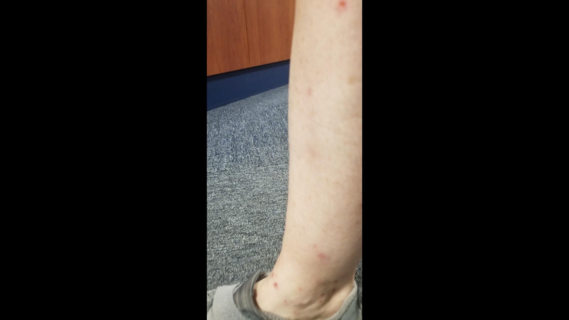 How to avoid getting bit by chiggers | ksdk.com