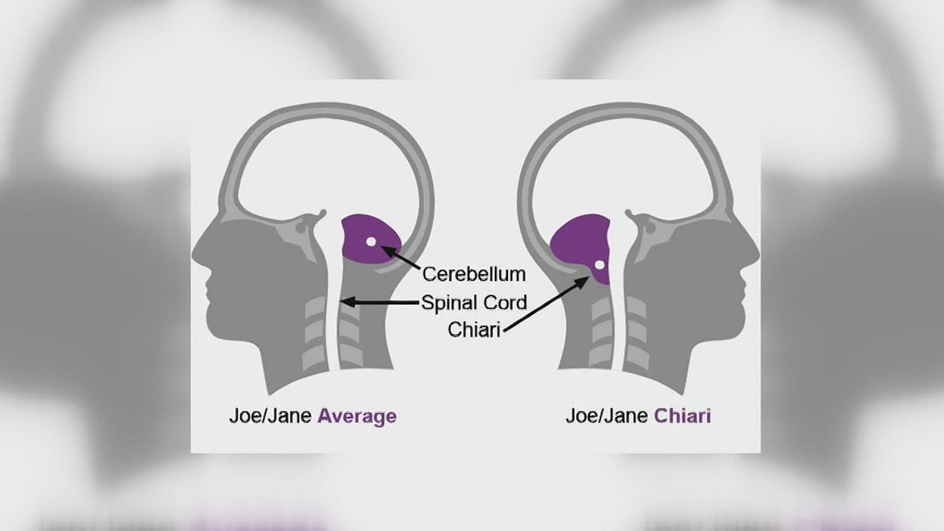 Conquer Chiari Walk Across America coming to Lake St. Louis | ksdk.com