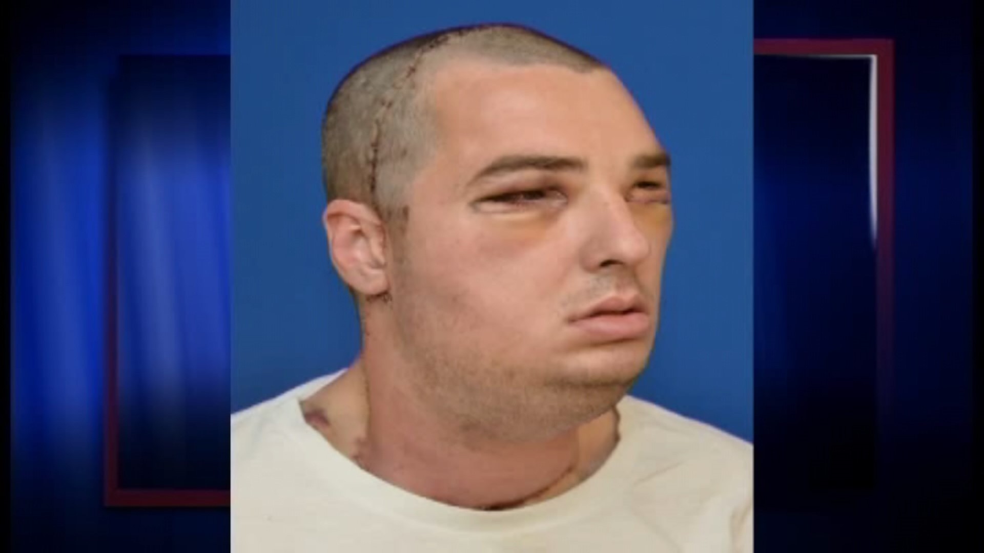 After surviving first-ever face transplant, man needs another medical ...